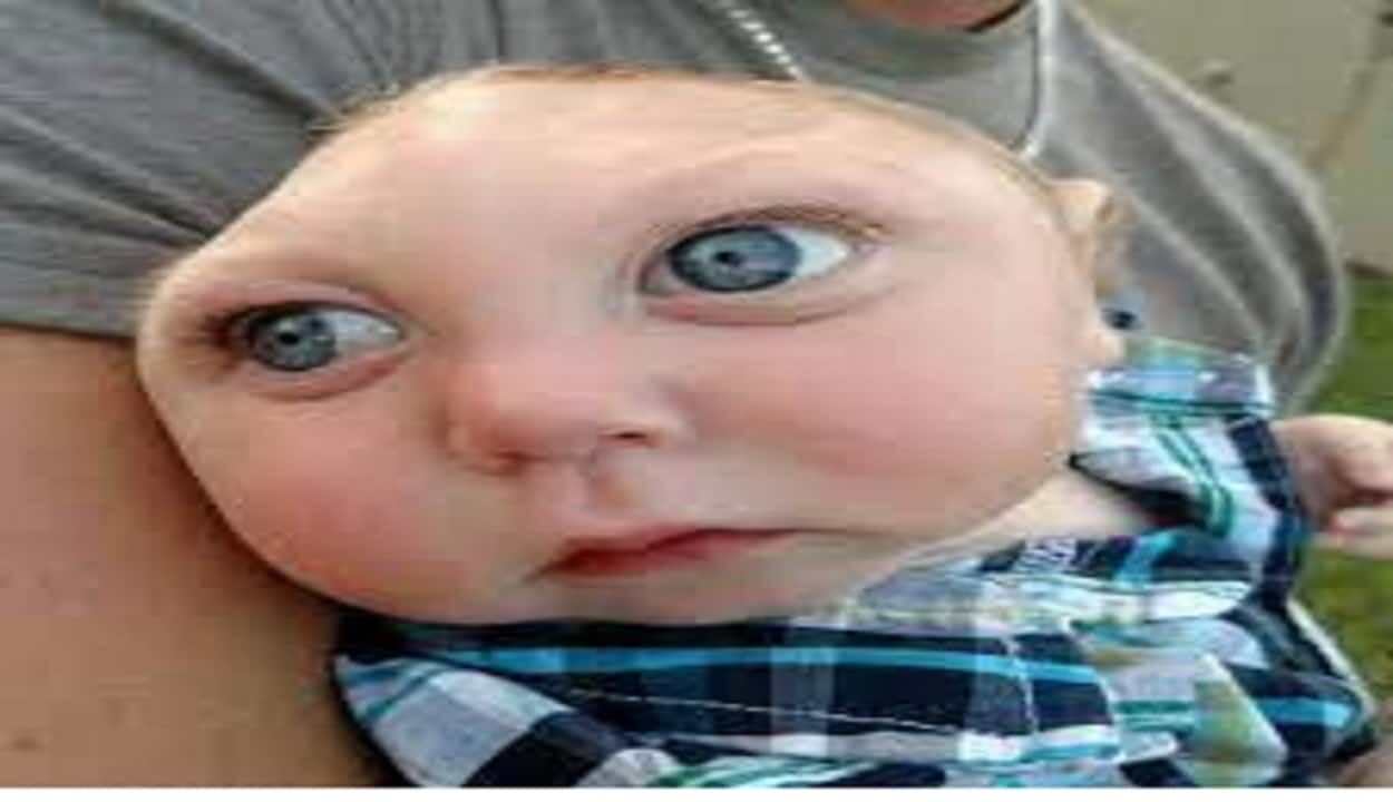 दुनिया का एक अनोखा एकलौता बच्चा जो बिना खोपड़ी के पैदा हुआ था, जानिये ...